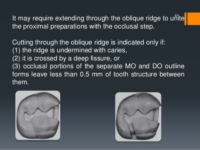 Class ii amalgam