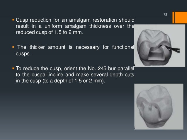 Class ii amalgam