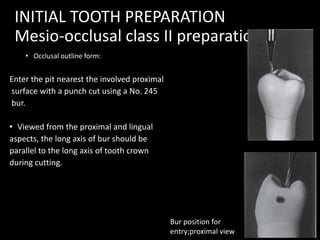 Class II amalgam | PPTX