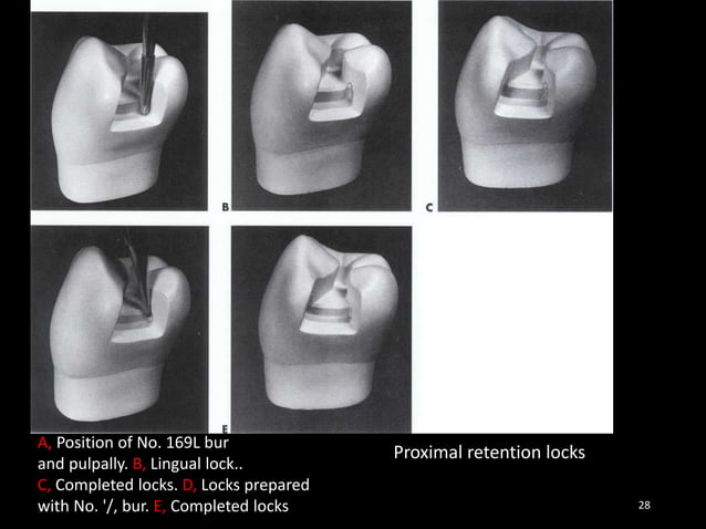 Class II amalgam | PPTX