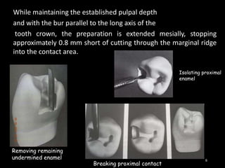 Class II amalgam | PPTX