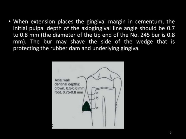 Class II amalgam | PPTX