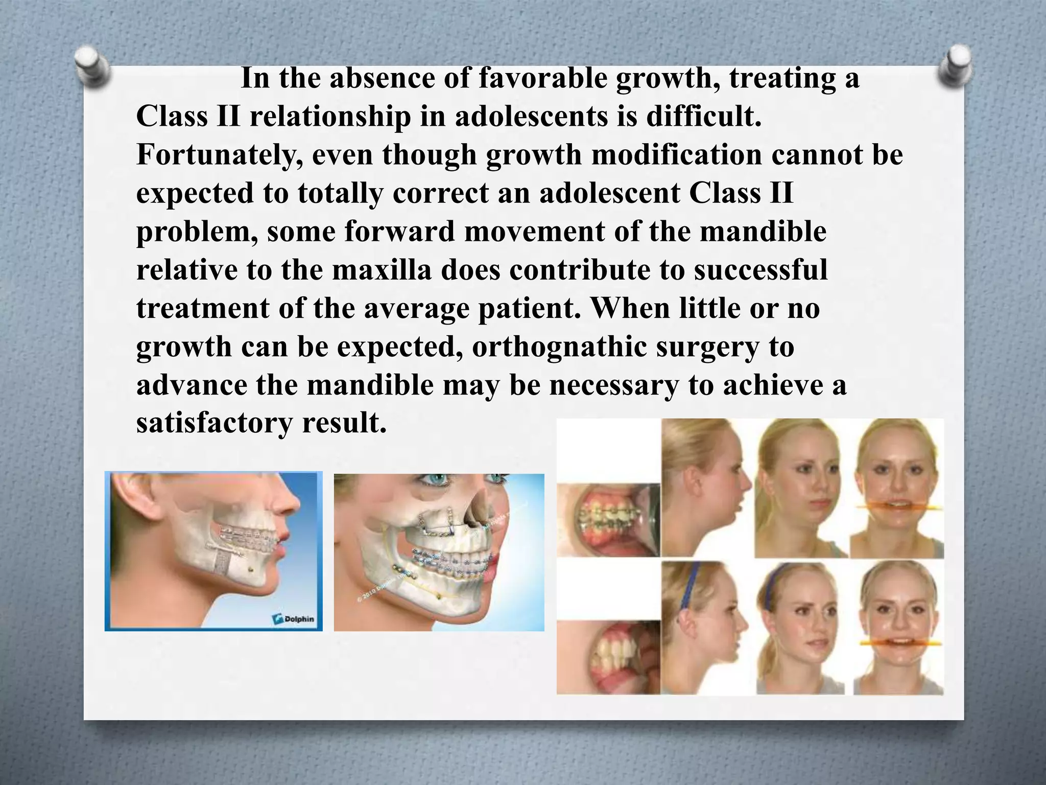 Class II Malocclusion (Camouflage Treatment) | PPTX