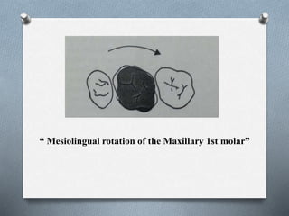 Class II Malocclusion (Camouflage Treatment) | PPTX