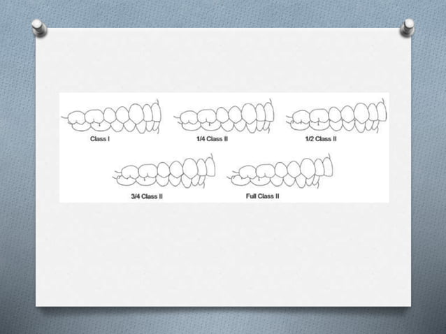 Class II Malocclusion (Camouflage Treatment) | PPTX | Dental Health ...