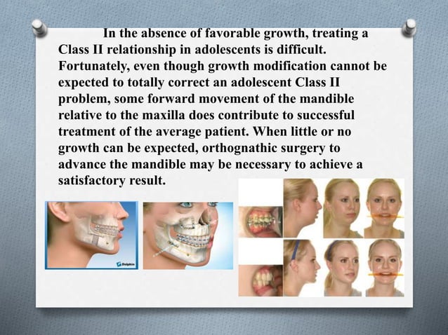 Class II Malocclusion (Camouflage Treatment) | PPTX | Dental Health ...