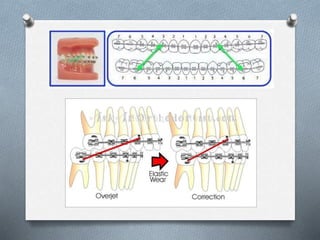 Class II Malocclusion (Camouflage Treatment) | PPTX