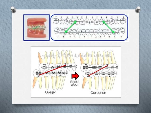 Class II Malocclusion (Camouflage Treatment) | PPTX | Dental Health ...