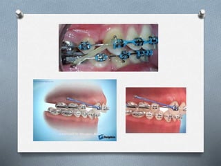 Class II Malocclusion (Camouflage Treatment) | PPTX