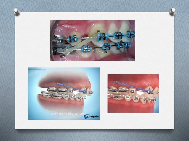 Class II Malocclusion (Camouflage Treatment) | PPTX | Dental Health ...