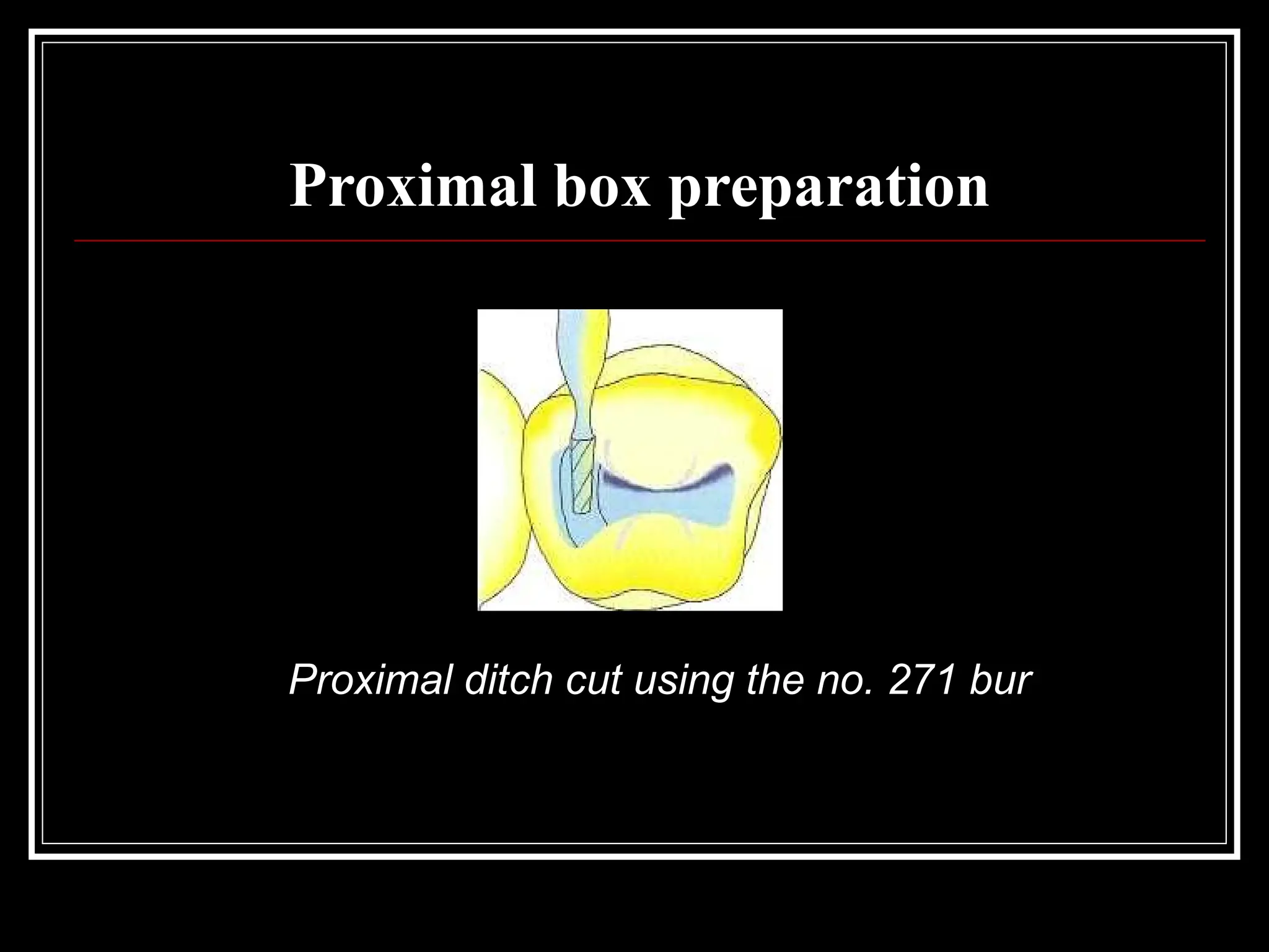 CLASS II CAST METAL RESTORATIONS.powerpoint | PPTX