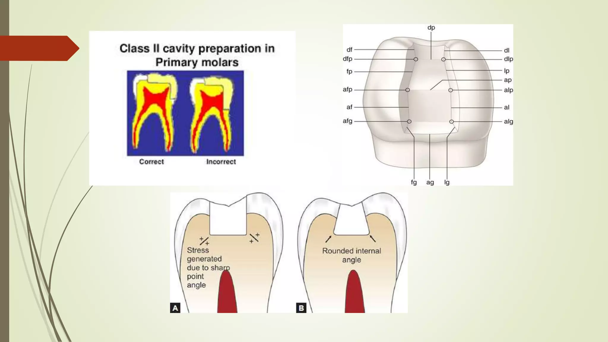 Class II cavity preparation | PPTX
