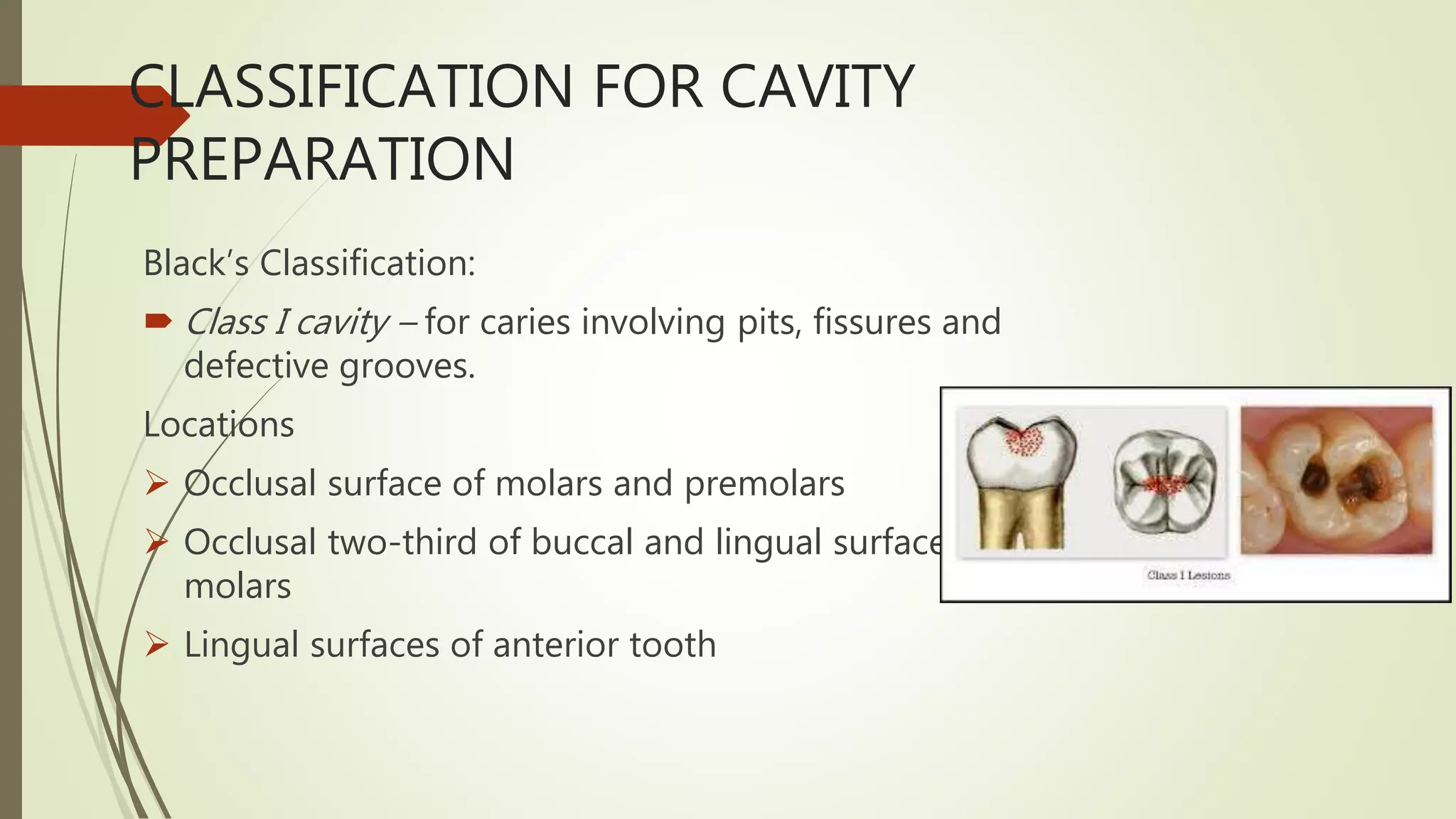 Class II cavity preparation | PPTX