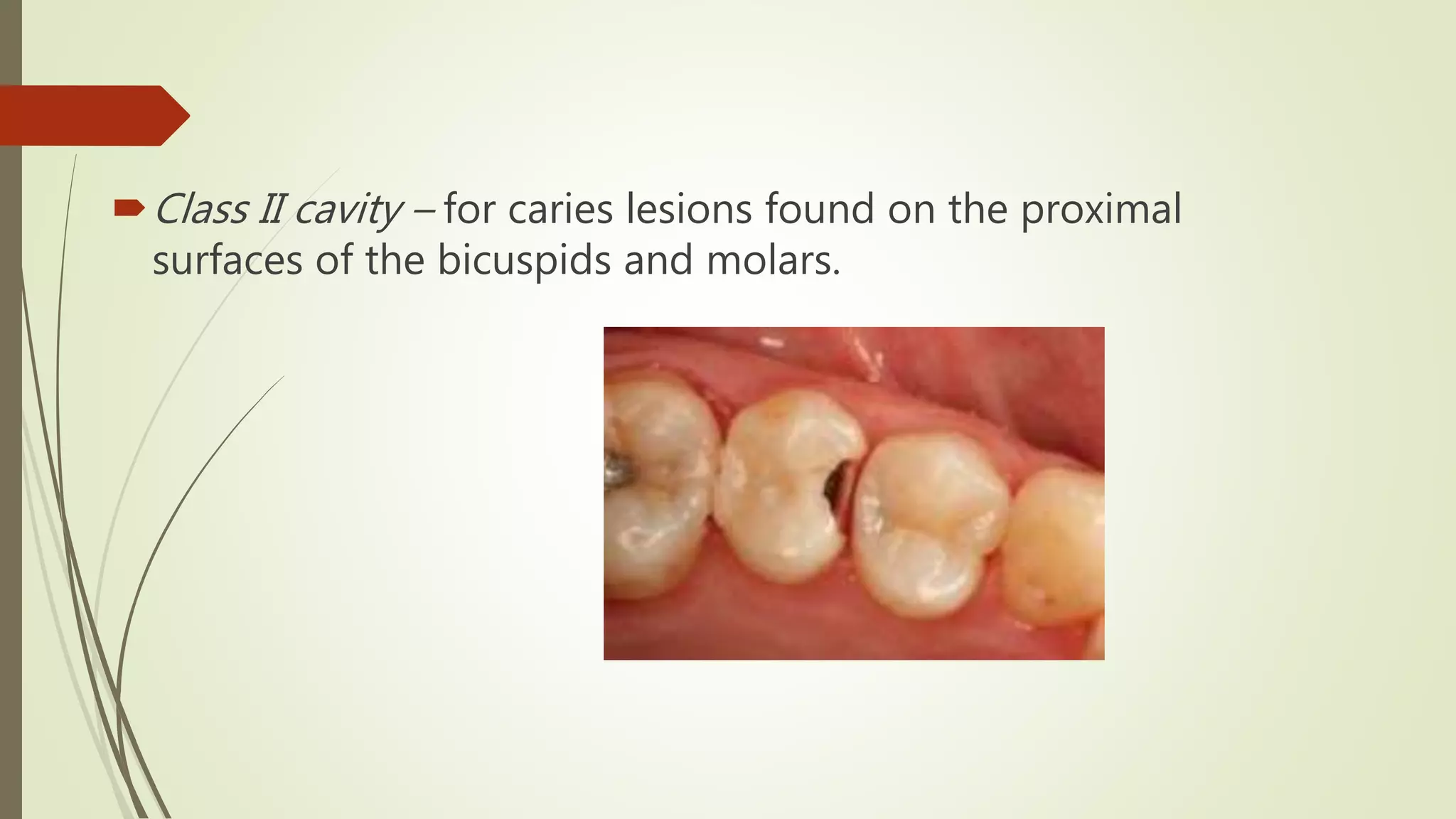 Class II cavity preparation | PPTX