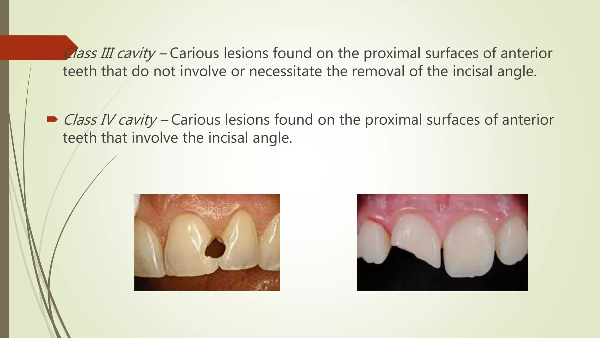 Class II cavity preparation | PPTX