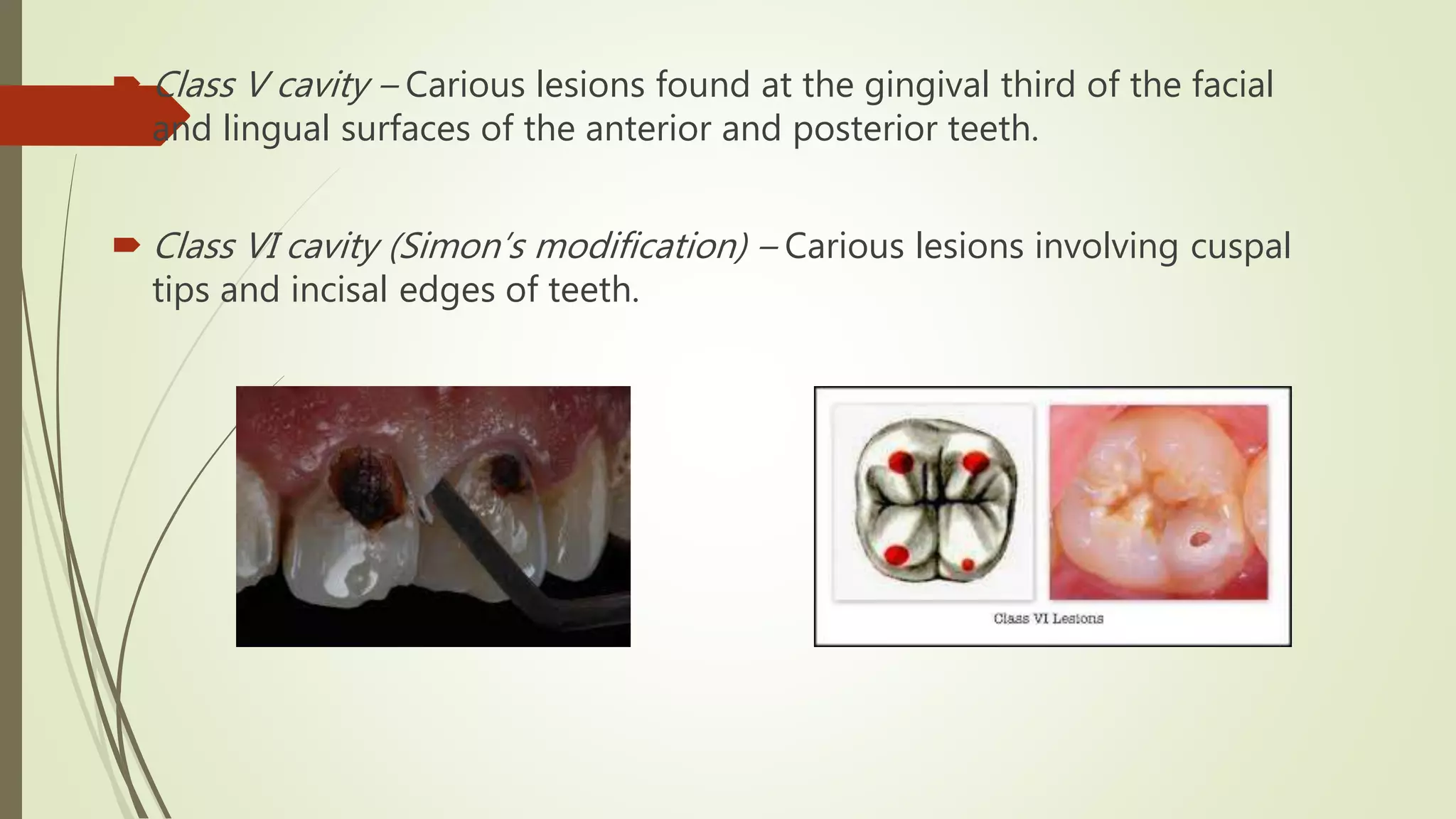Class II cavity preparation | PPTX