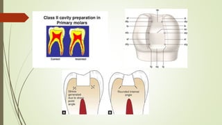 Class II cavity preparation | PPTX