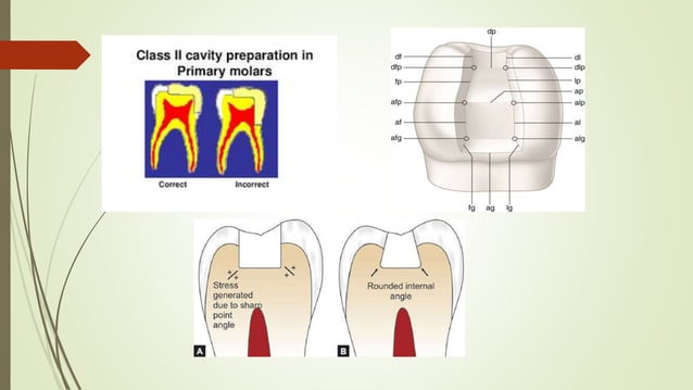 Class II cavity preparation | PPTX | Dental Health | Diseases and ...