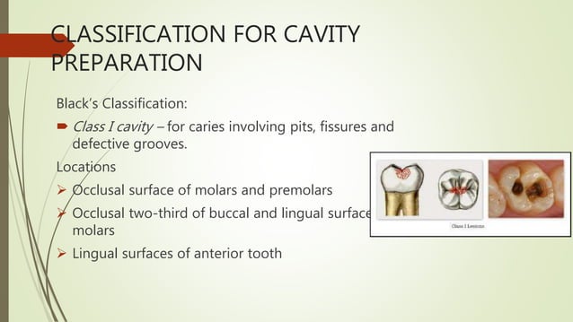 Class II cavity preparation | PPTX | Dental Health | Diseases and ...