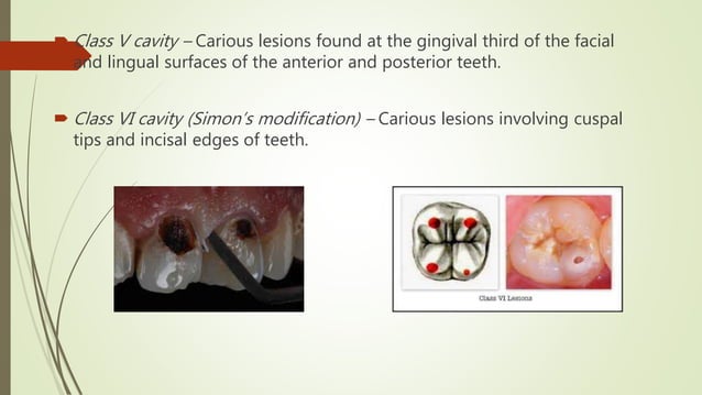 Class II cavity preparation | PPTX | Dental Health | Diseases and ...