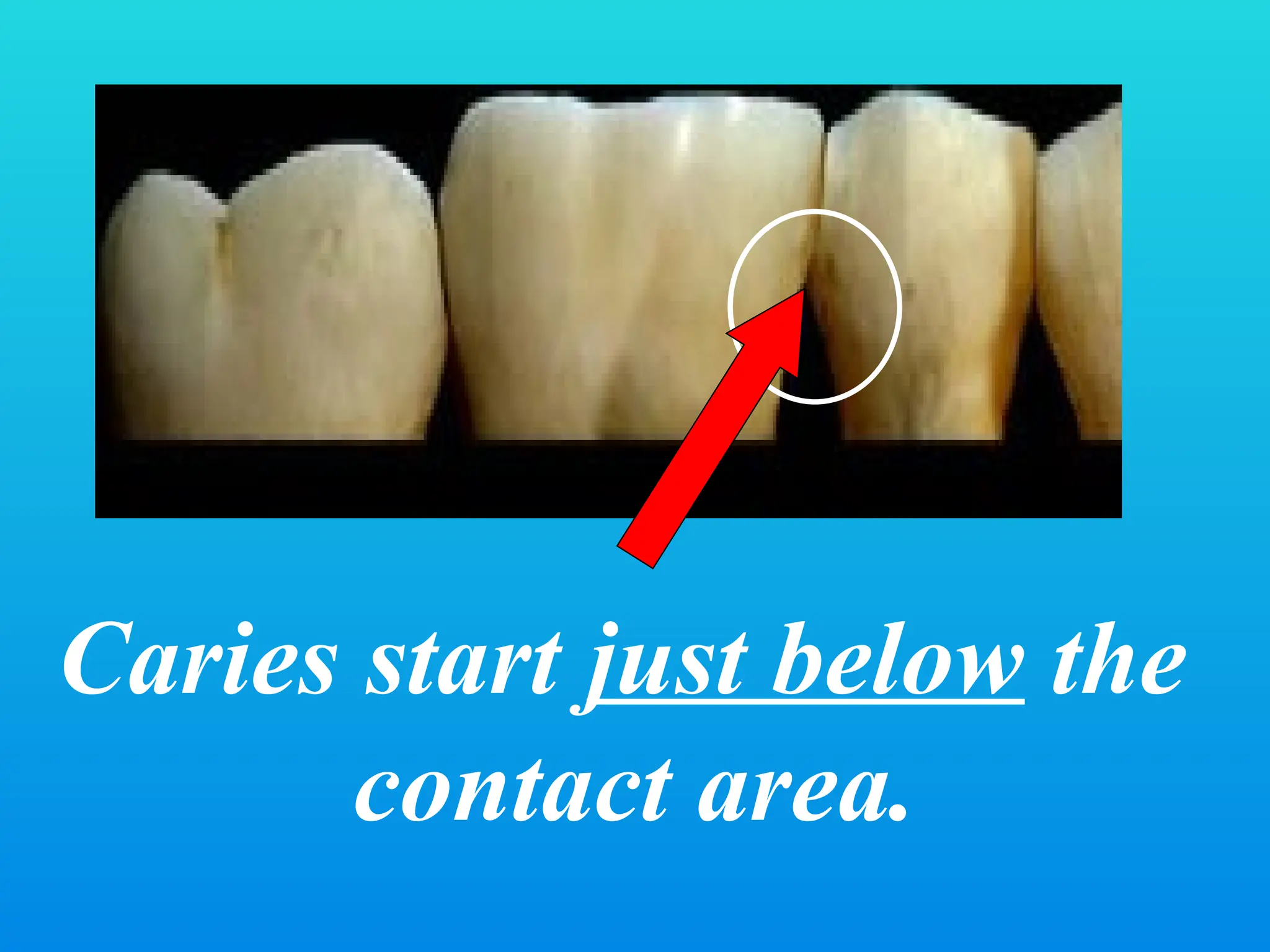 CLASS II CAVITY PREPARATION for amalgam | PPTX