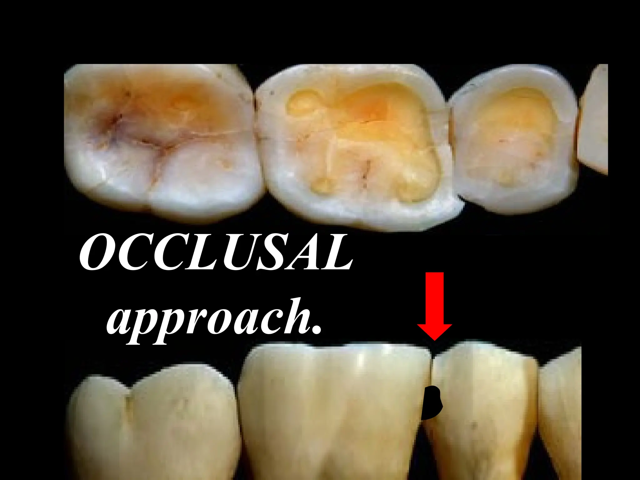 CLASS II CAVITY PREPARATION for amalgam | PPTX