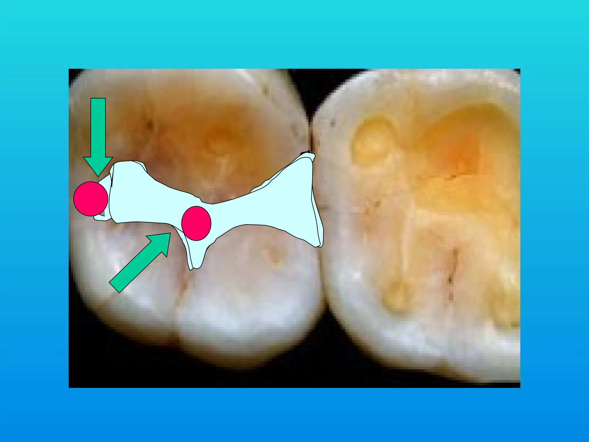 CLASS II CAVITY PREPARATION for amalgam | PPTX