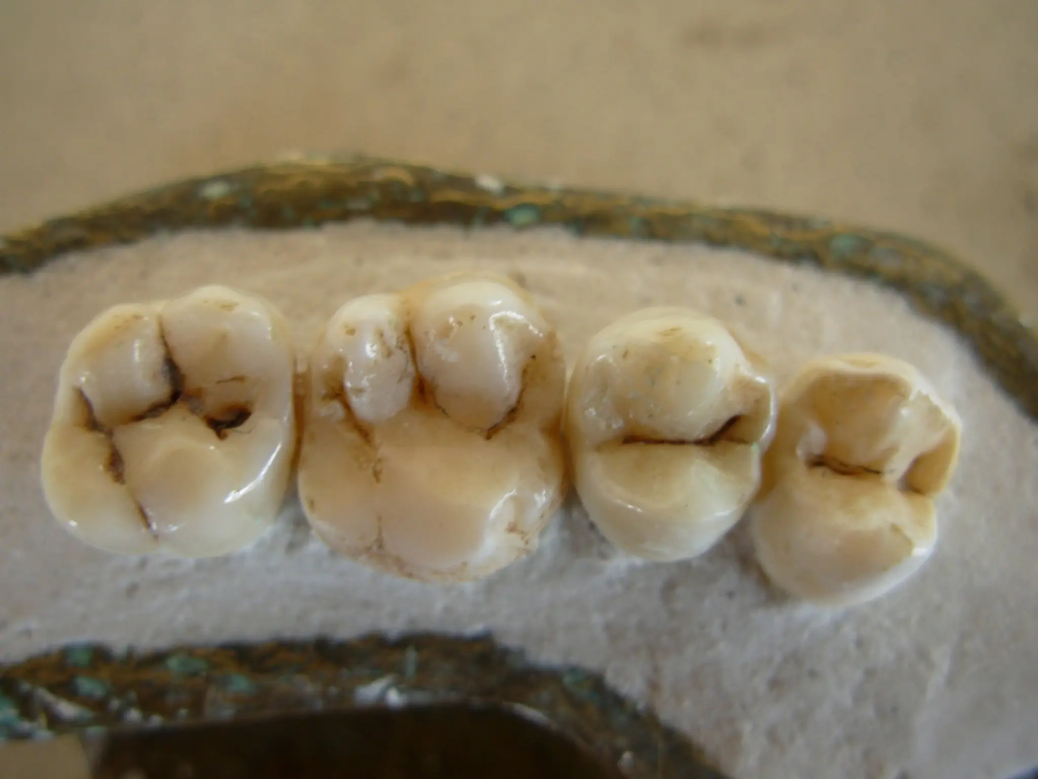 CLASS II CAVITY PREPARATION for amalgam | PPTX