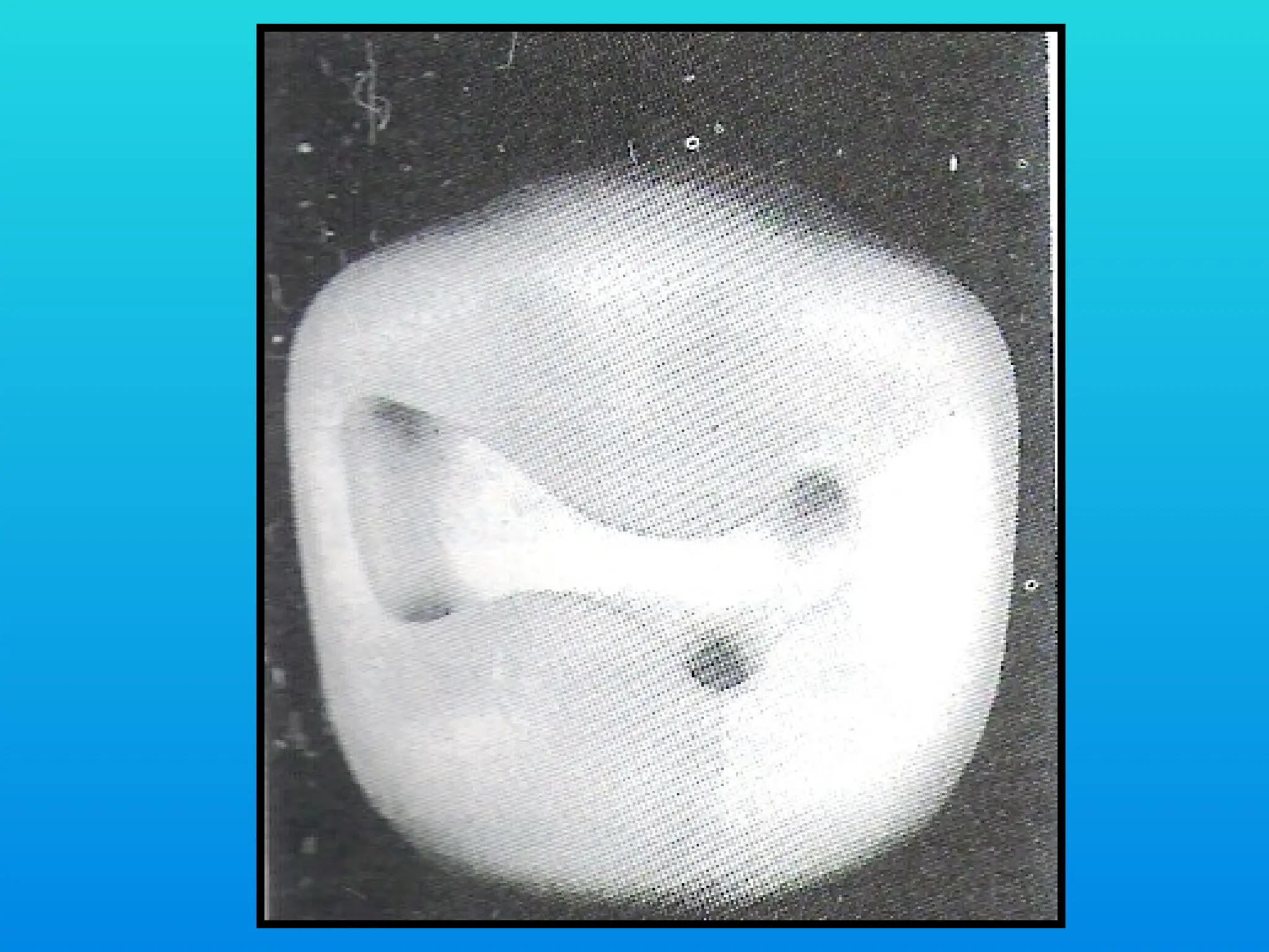 CLASS II CAVITY PREPARATION for amalgam | PPTX | Oral care | Personal Care