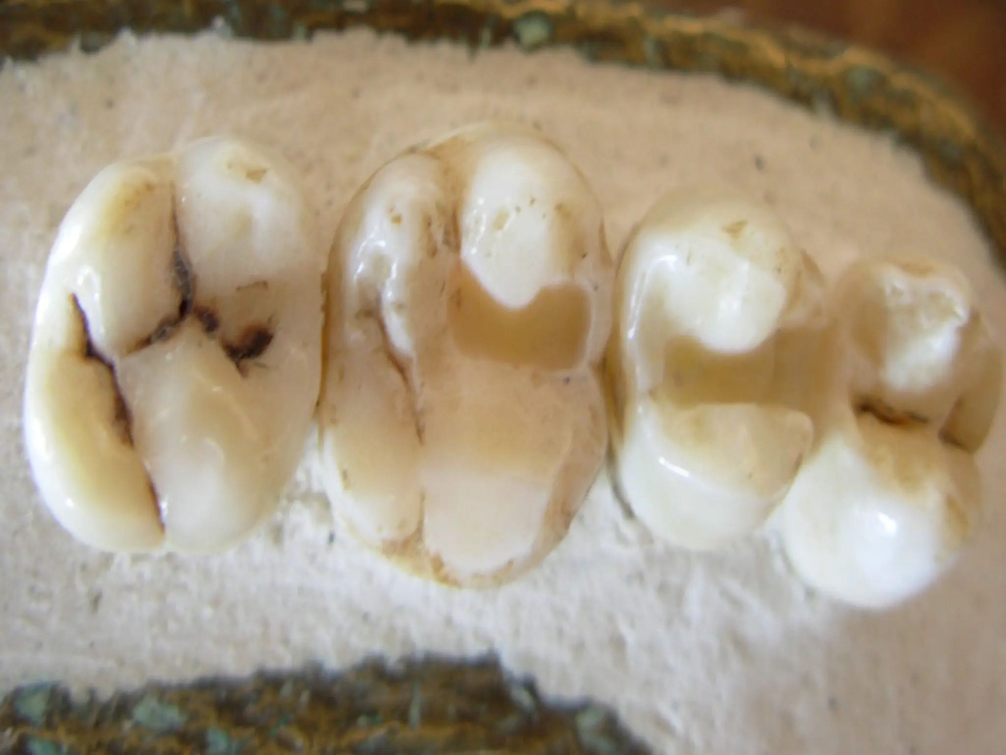 CLASS II CAVITY PREPARATION for amalgam | PPTX