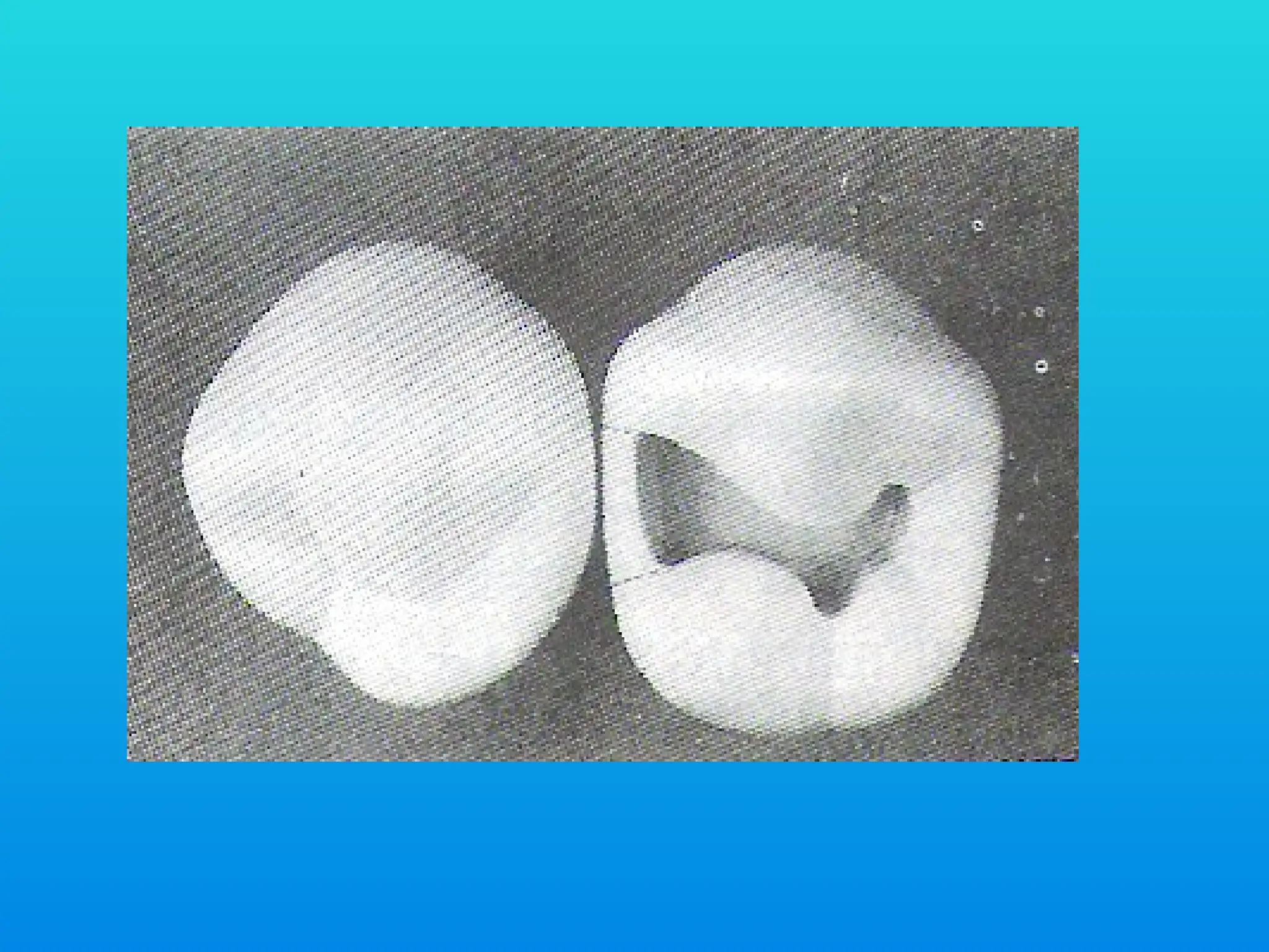 CLASS II CAVITY PREPARATION for amalgam | PPTX