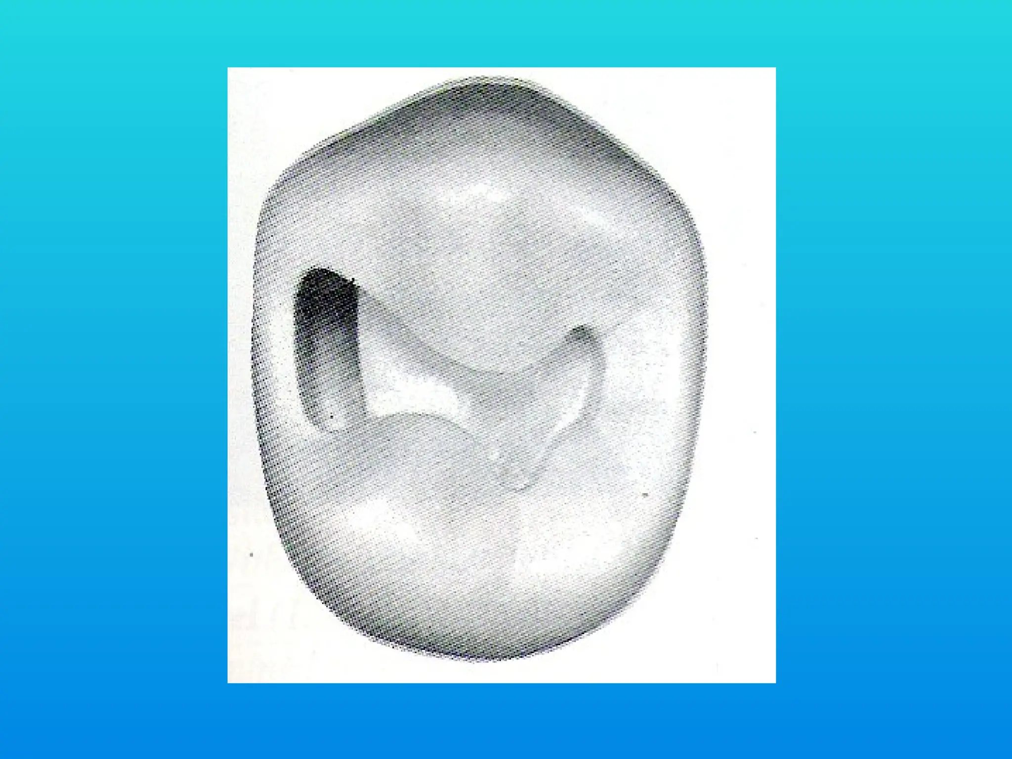 CLASS II CAVITY PREPARATION for amalgam | PPTX