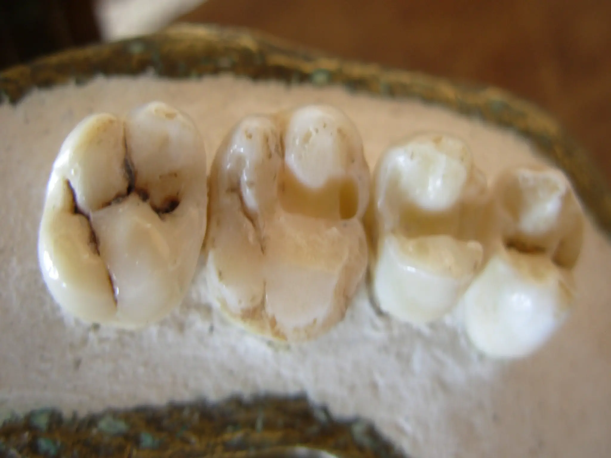 CLASS II CAVITY PREPARATION for amalgam | PPTX