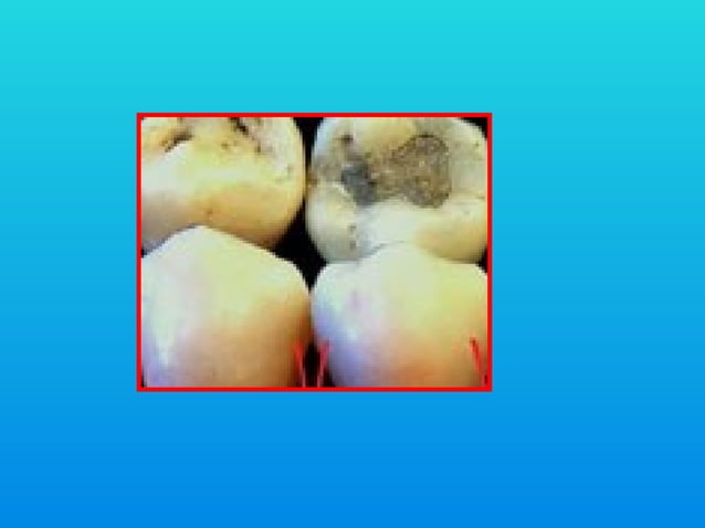 CLASS II CAVITY PREPARATION for amalgam | PPTX | Oral care | Personal Care