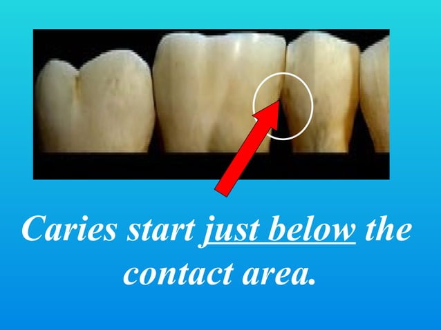 CLASS II CAVITY PREPARATION for amalgam | PPTX | Oral care | Personal Care