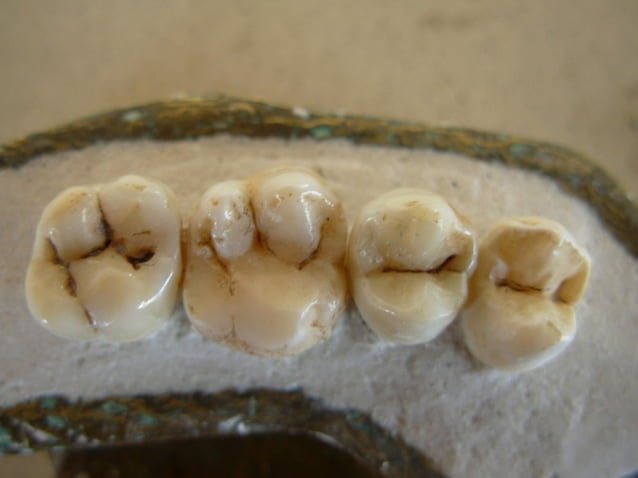 CLASS II CAVITY PREPARATION for amalgam | PPTX | Oral care | Personal Care