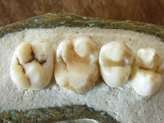 CLASS II CAVITY PREPARATION for amalgam | PPTX | Oral care | Personal Care