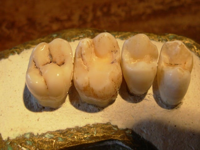 CLASS II CAVITY PREPARATION for amalgam | PPTX | Oral care | Personal Care