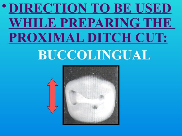 CLASS II CAVITY PREPARATION for amalgam | PPTX | Oral care | Personal Care