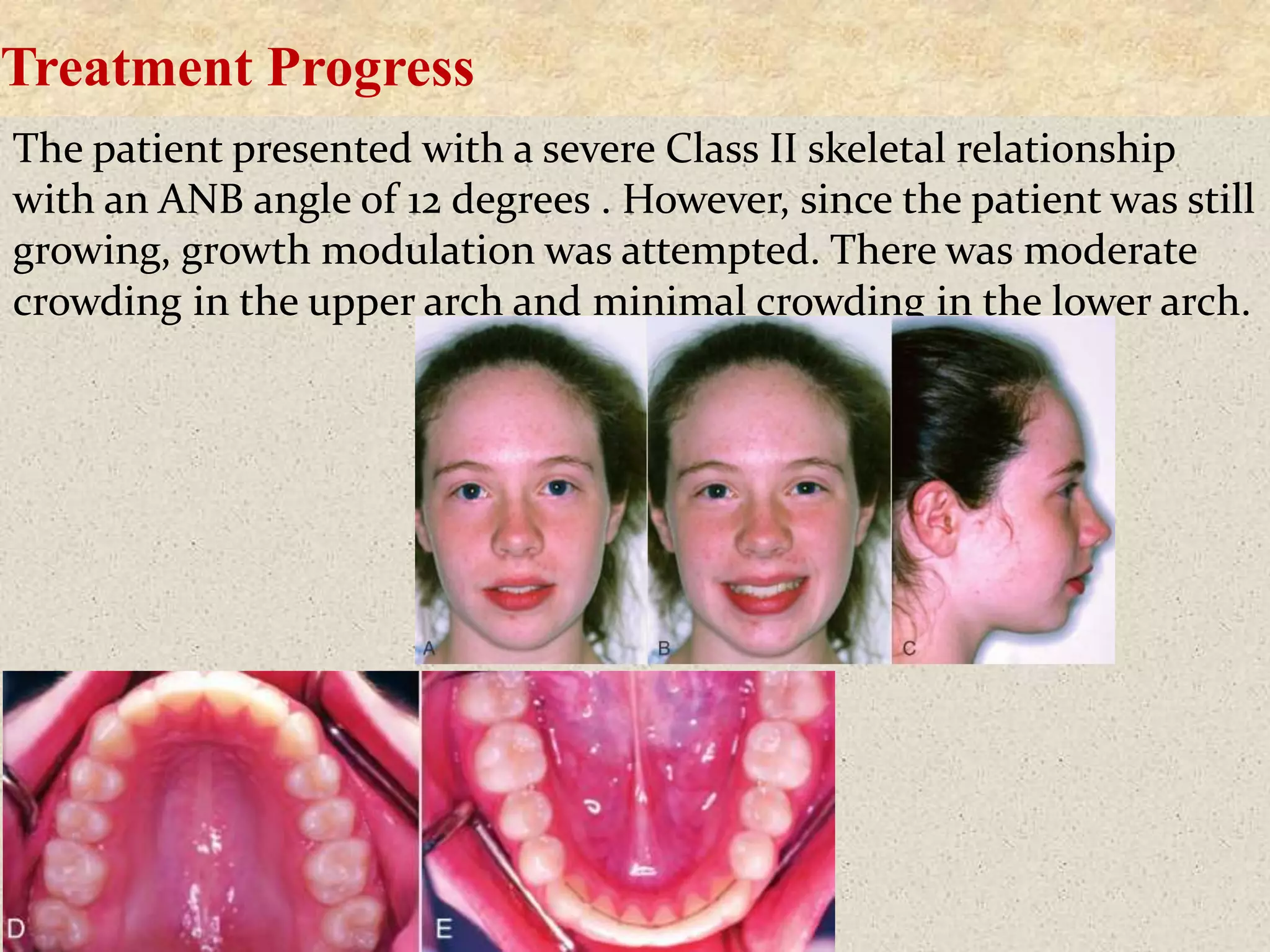Class II correction with an intermaxillary fixed noncompliance ...