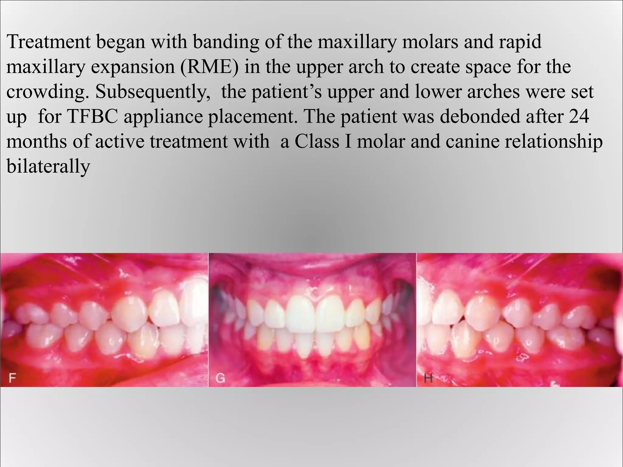 Class II correction with an intermaxillary fixed noncompliance ...