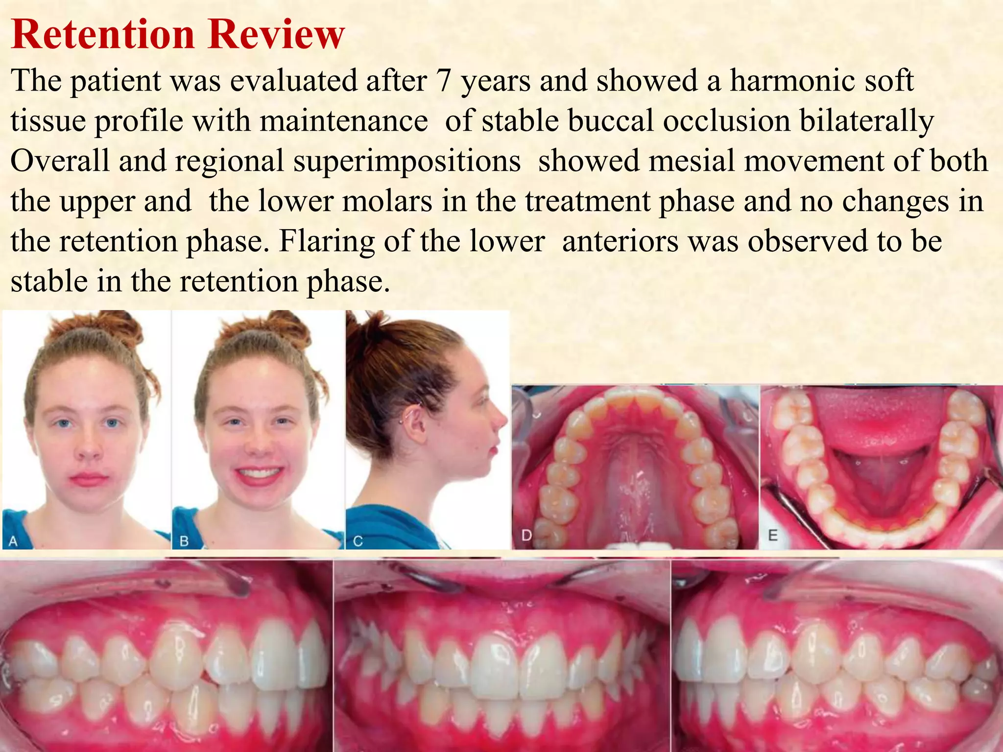 Class II correction with an intermaxillary fixed noncompliance ...