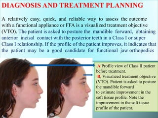 Class II correction with an intermaxillary fixed noncompliance ...