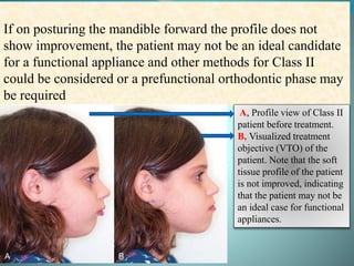 Class II correction with an intermaxillary fixed noncompliance ...