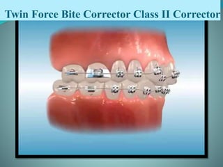 Class II correction with an intermaxillary fixed noncompliance ...
