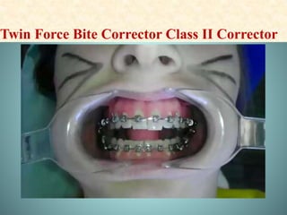 Class II correction with an intermaxillary fixed noncompliance ...