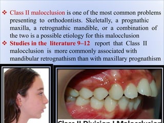 Class II correction with an intermaxillary fixed noncompliance ...