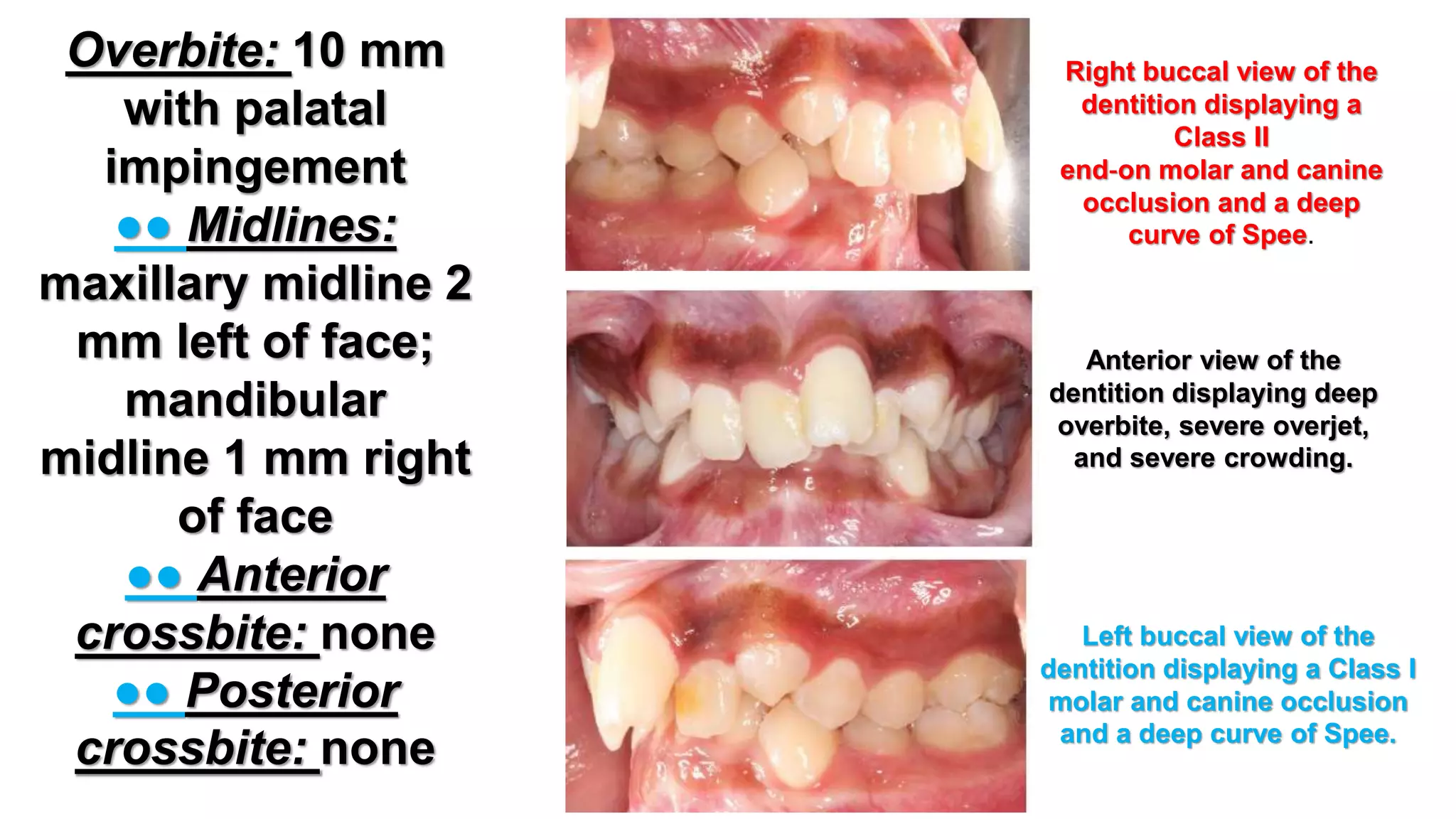 orthodontic correction of class II div 1 extraction of 4 bicuspids | PPTX