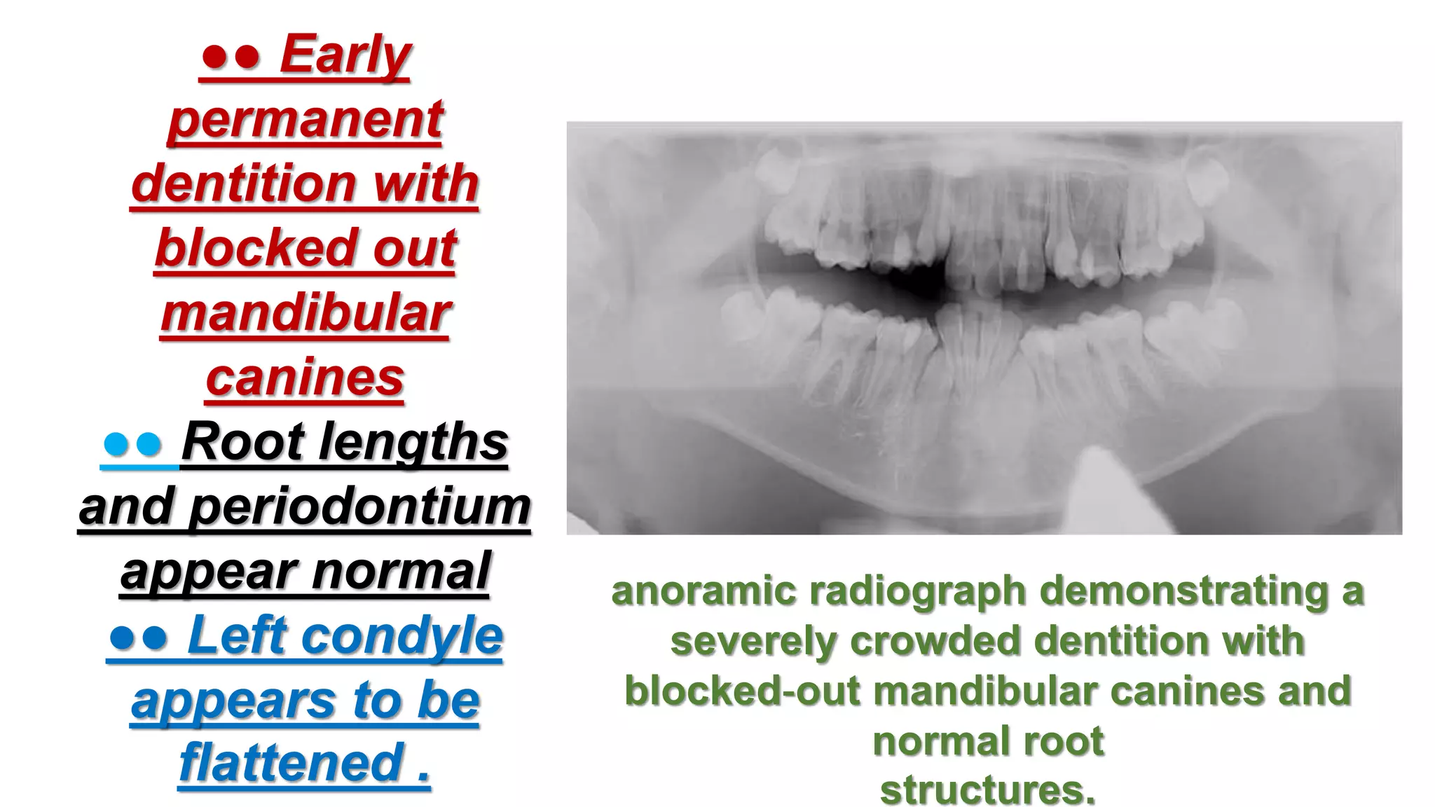 orthodontic correction of class II div 1 extraction of 4 bicuspids | PPTX