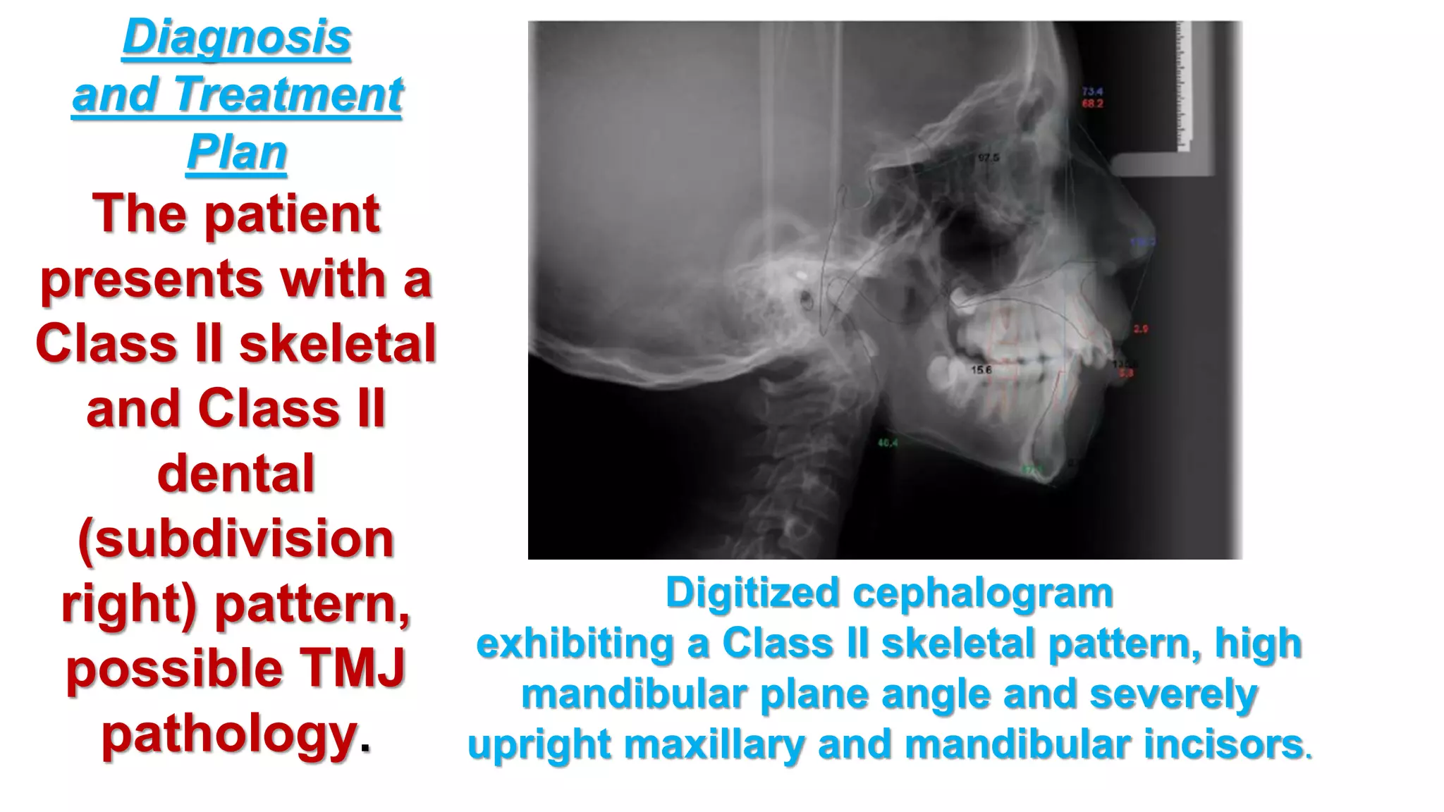 orthodontic correction of class II div 1 extraction of 4 bicuspids | PPTX
